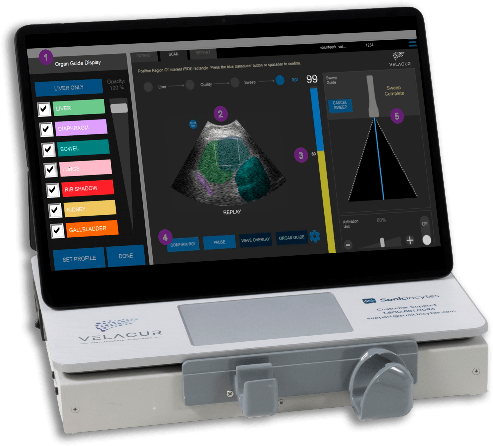Point of Care Ultrasound for Fatty Liver Disease | VELACUR
